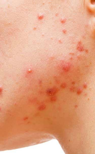 How to fight and treat acne - BeOnMe