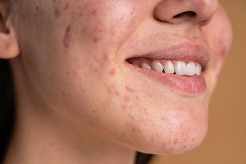 How to fight and treat acne - BeOnMe