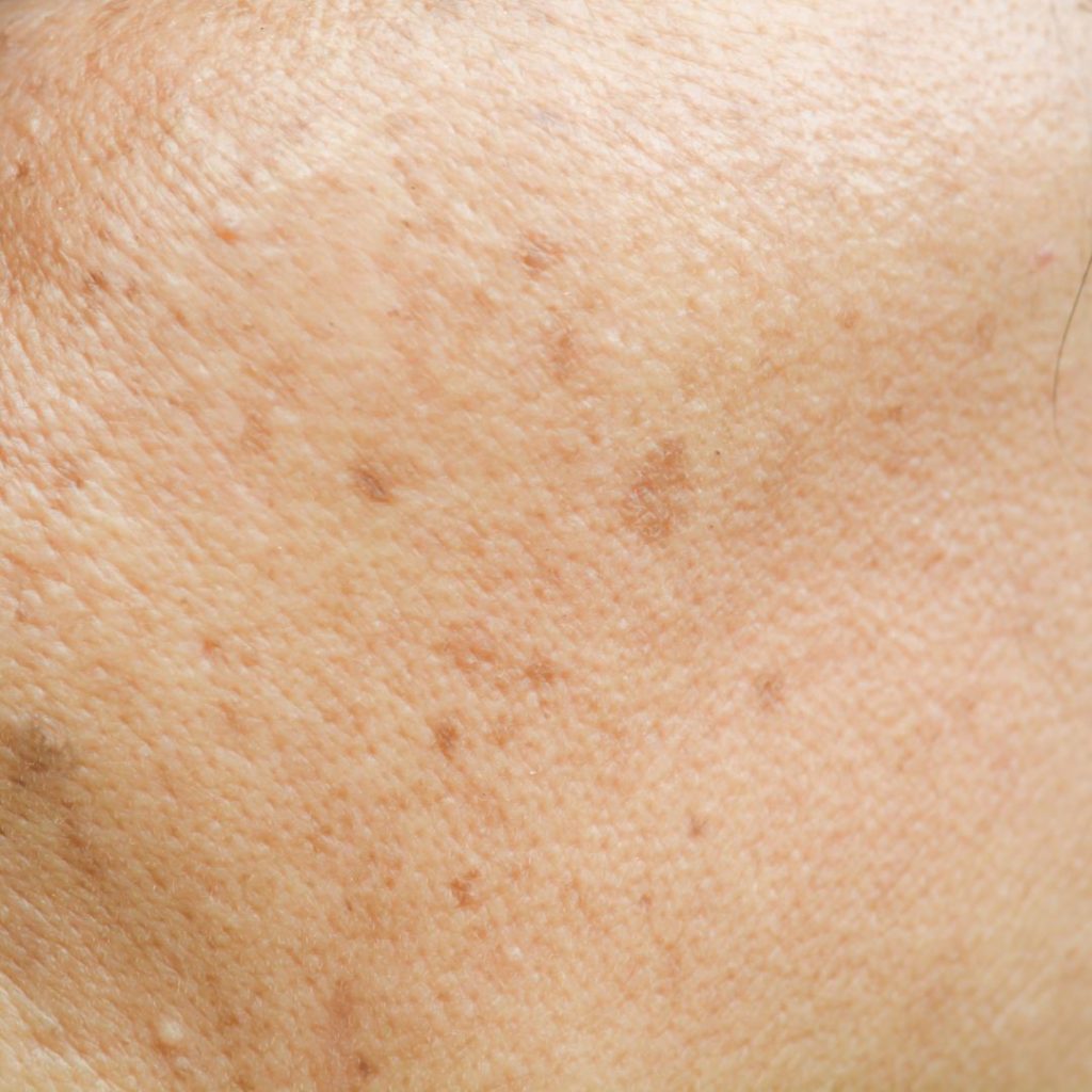 How to get rid of skin spots from your face - BeOnMe