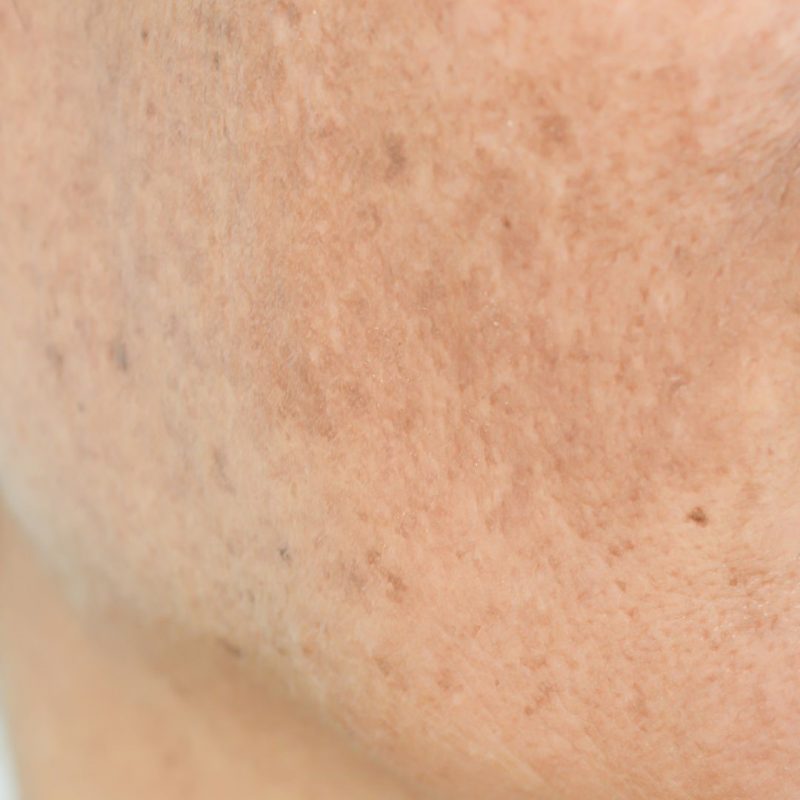 How to get rid of skin spots from your face - BeOnMe