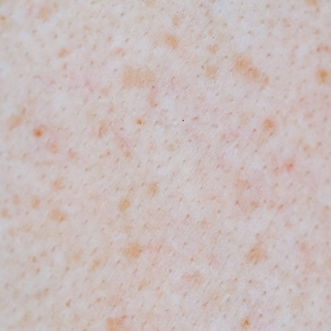 Come eliminare le macchie dal viso - BeOnMe