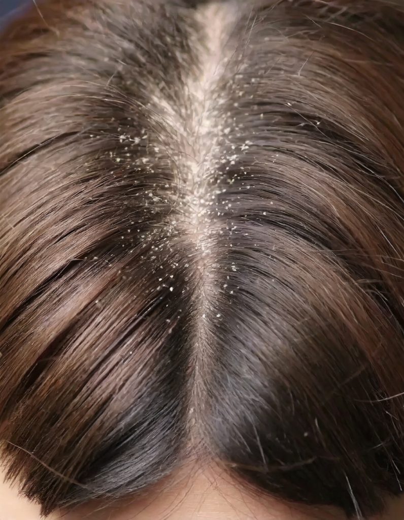 Come eliminare la forfora: Guida a cause, rimedi e prevenzione - BeOnMe