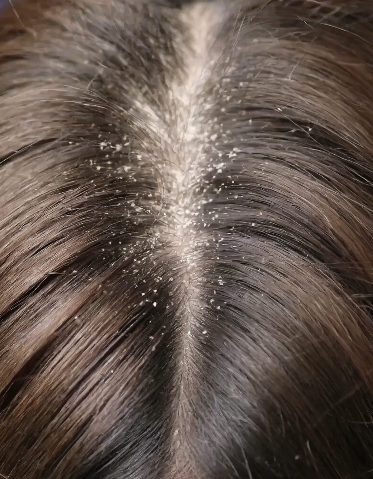 How to eliminate dandruff: A guide to causes, remedies, and prevention ...