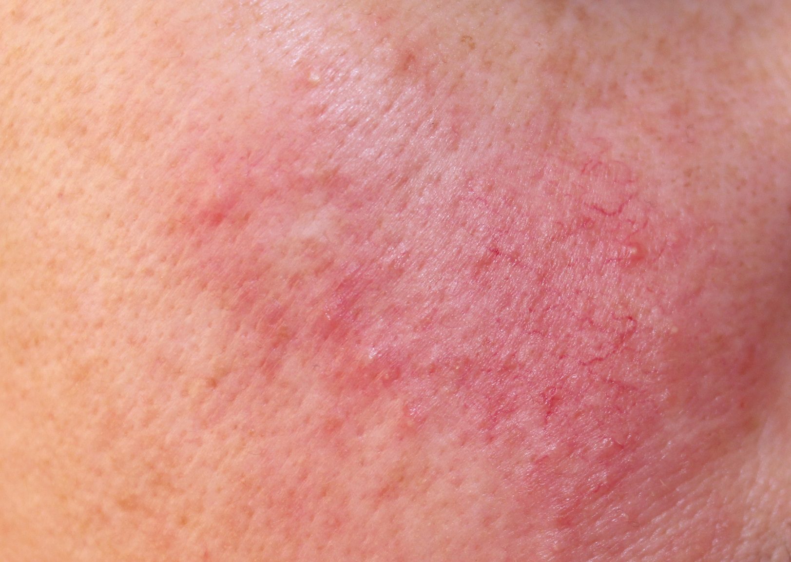 Rosácea: qué es, cómo tratarla y cuáles son los remedios naturales - BeOnMe