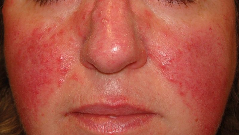 Rosacea: what it is, how to treat it and what are the natural remedies ...