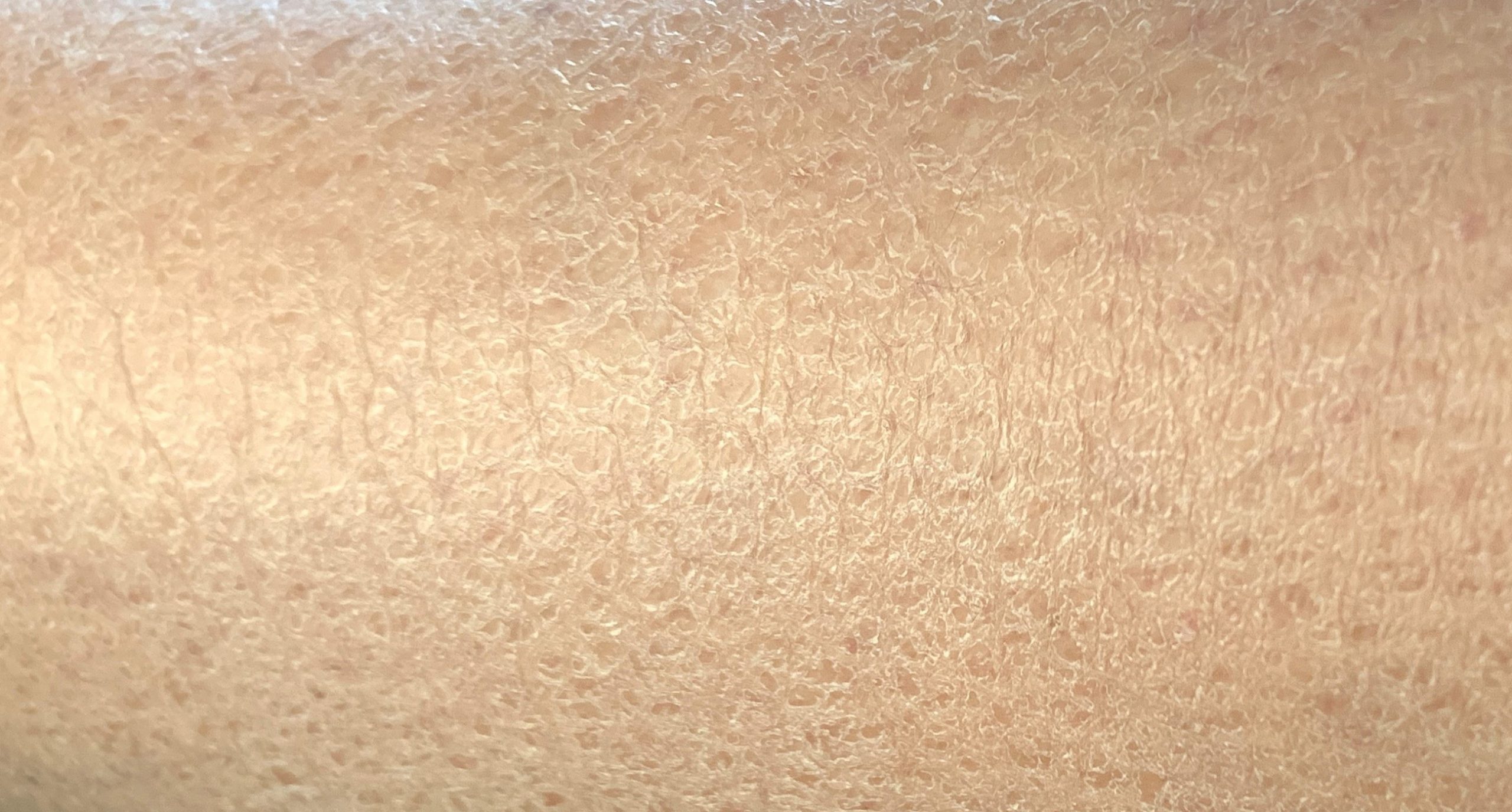 Strawberry legs: What to do in 3 Steps - BeOnMe